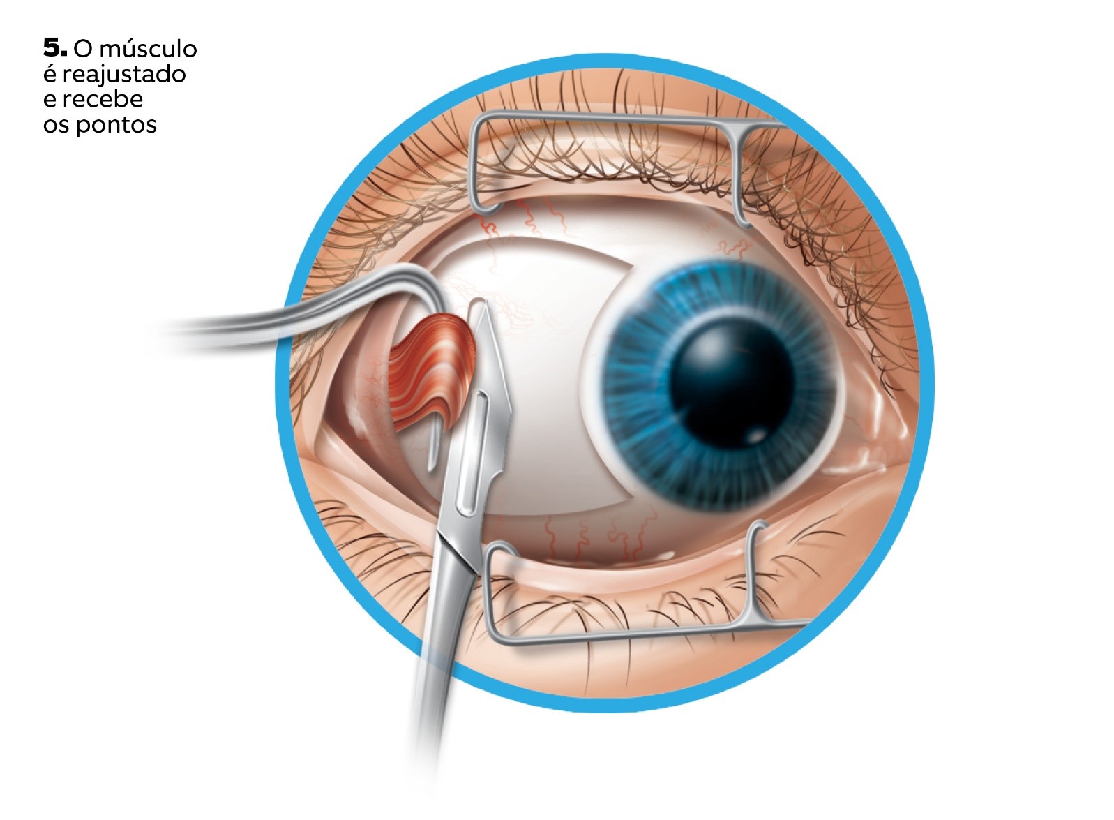 Cirurgia De Estrabismo Recuperação - RETOEDU