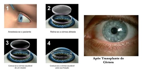 Transplante de Córnea - Centro de Cirurgia Ocular